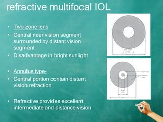 Intraocular lens | PDF