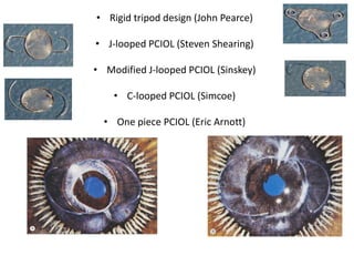 Intraocular lenses | PPTX