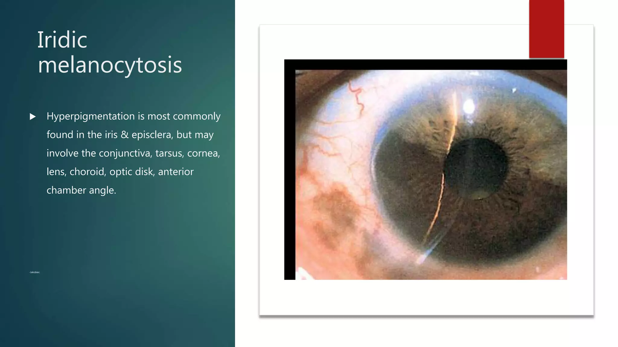 Intraocular tumors | PPTX