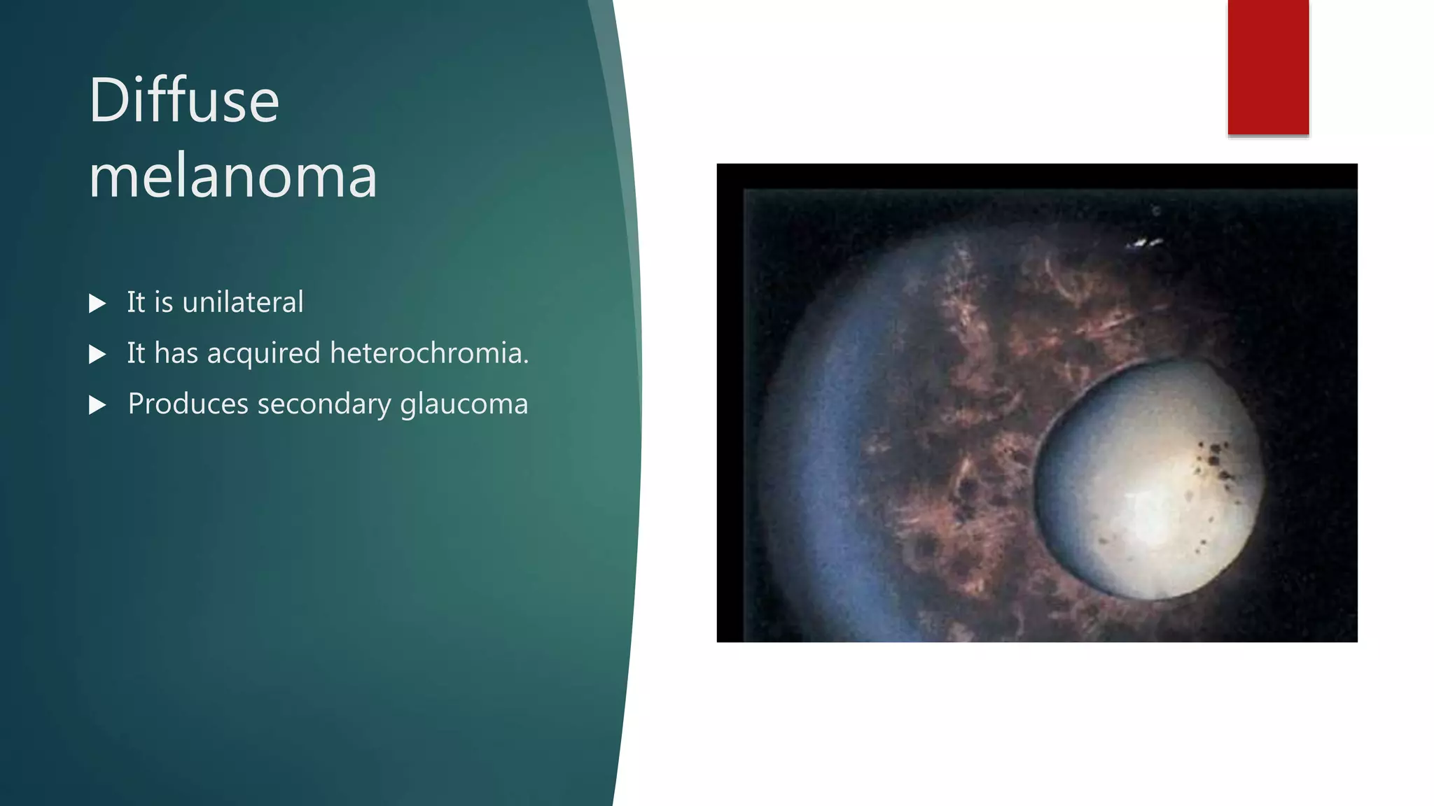 Intraocular tumors | PPTX