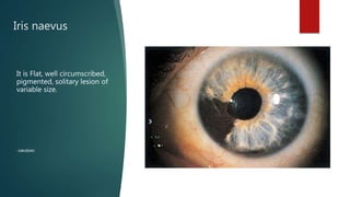 Intraocular tumors | PPTX