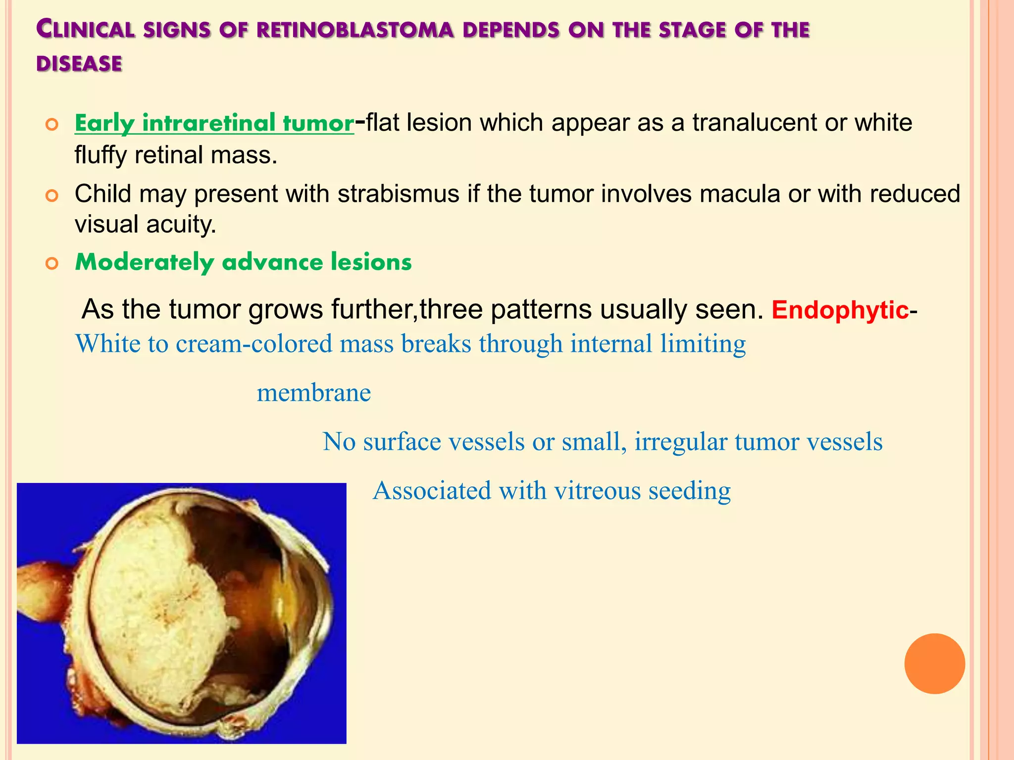 Intraocular tumors | PPTX