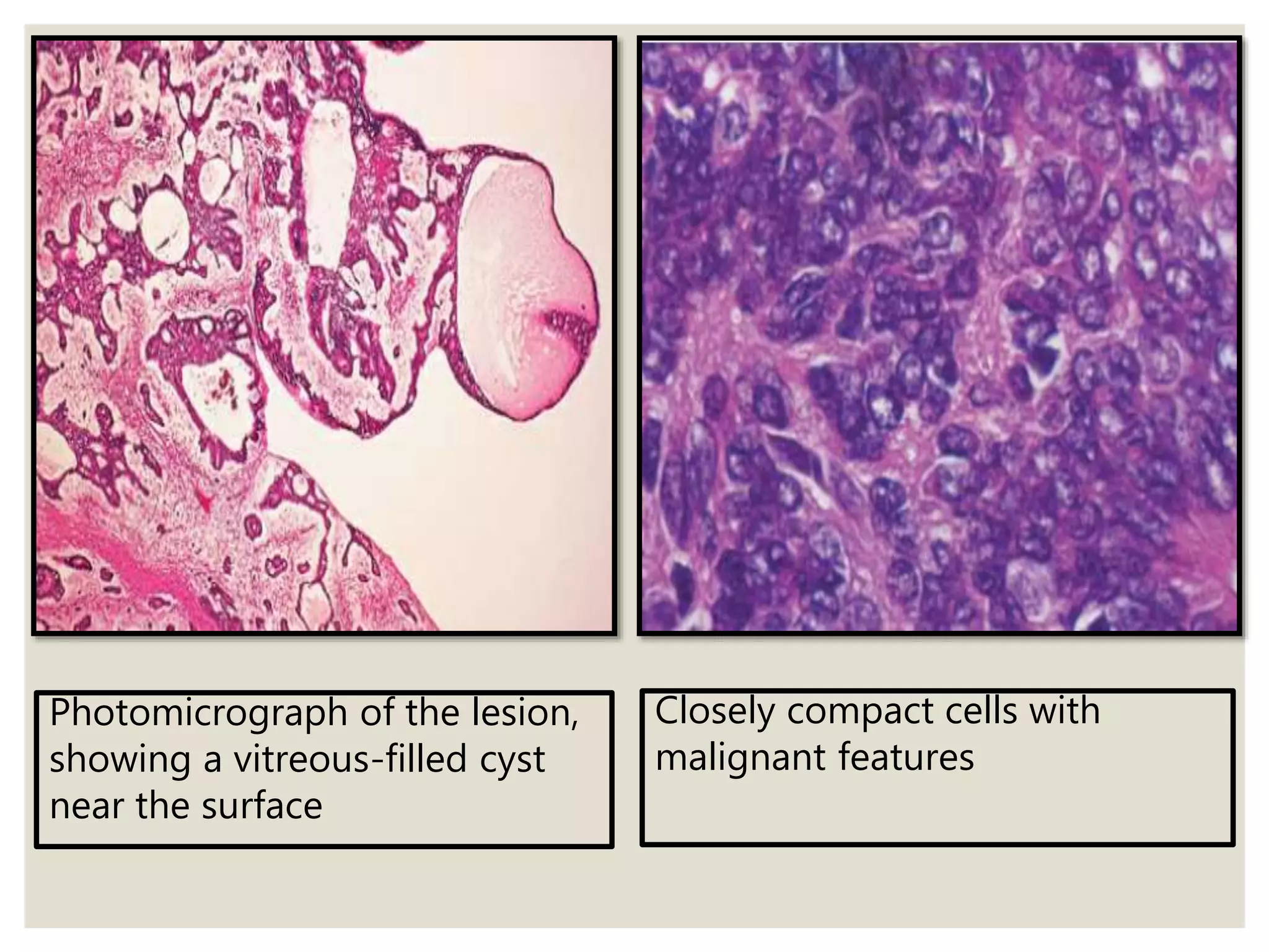 Intraocular tumors 18 | PPTX