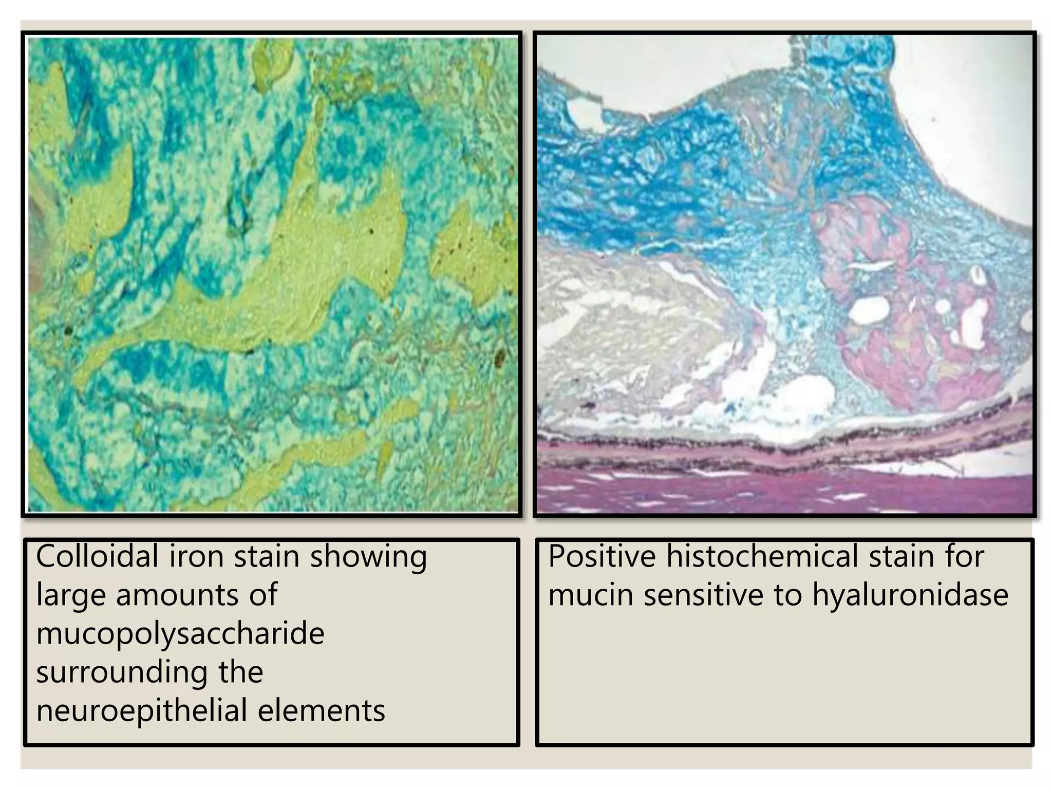 Intraocular tumors 18 | PPTX