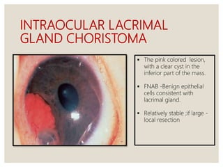 Intraocular tumors 18 | PPTX