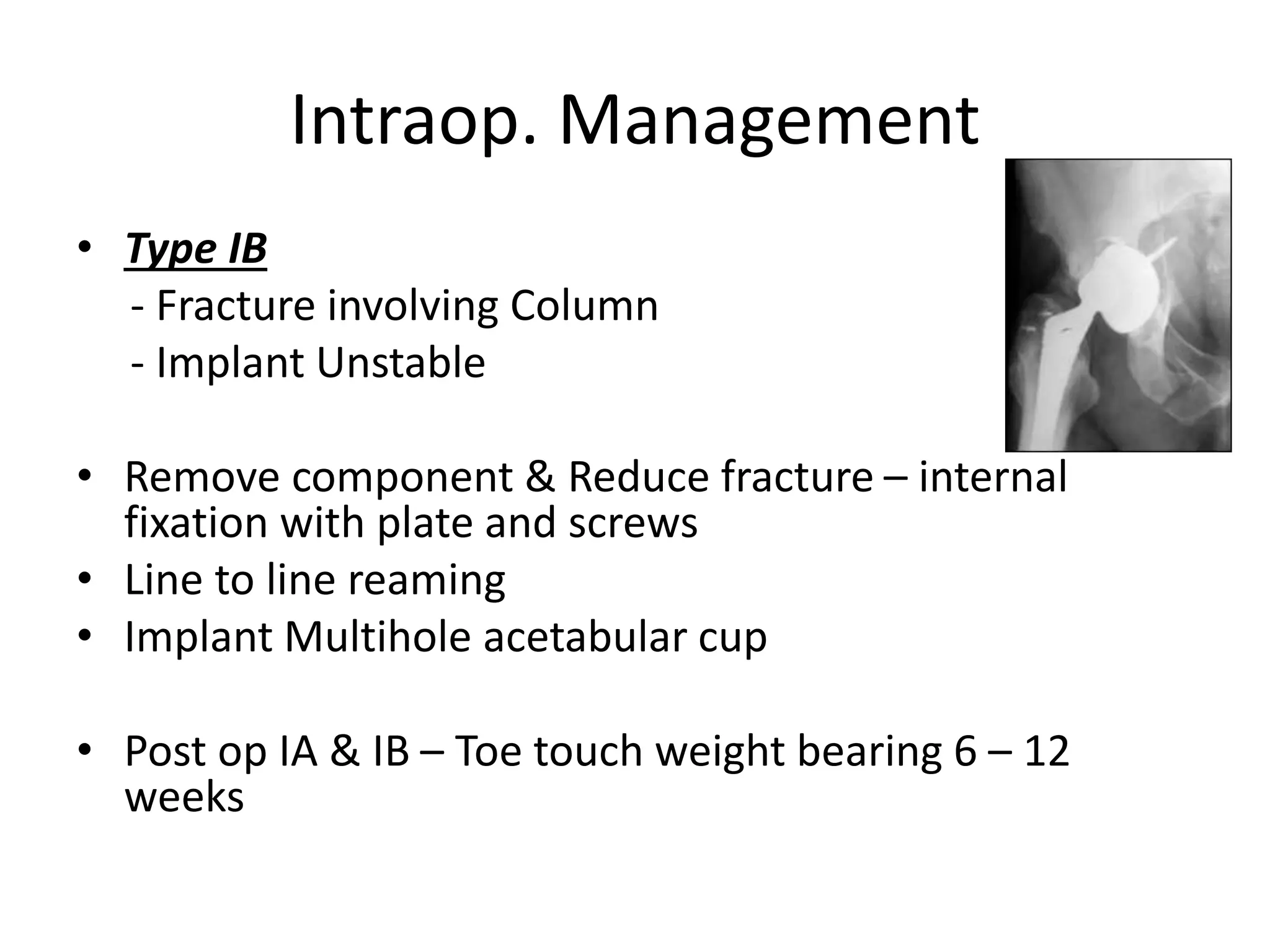 Intraoperative acetabular fracture and pelvic discontinuity in thr | PPTX