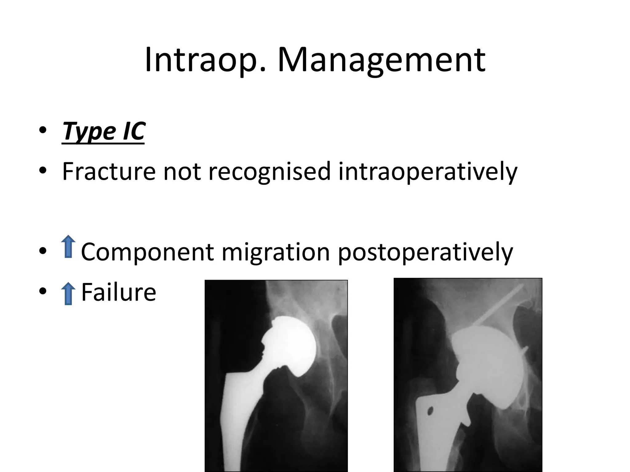 Intraoperative acetabular fracture and pelvic discontinuity in thr | PPTX