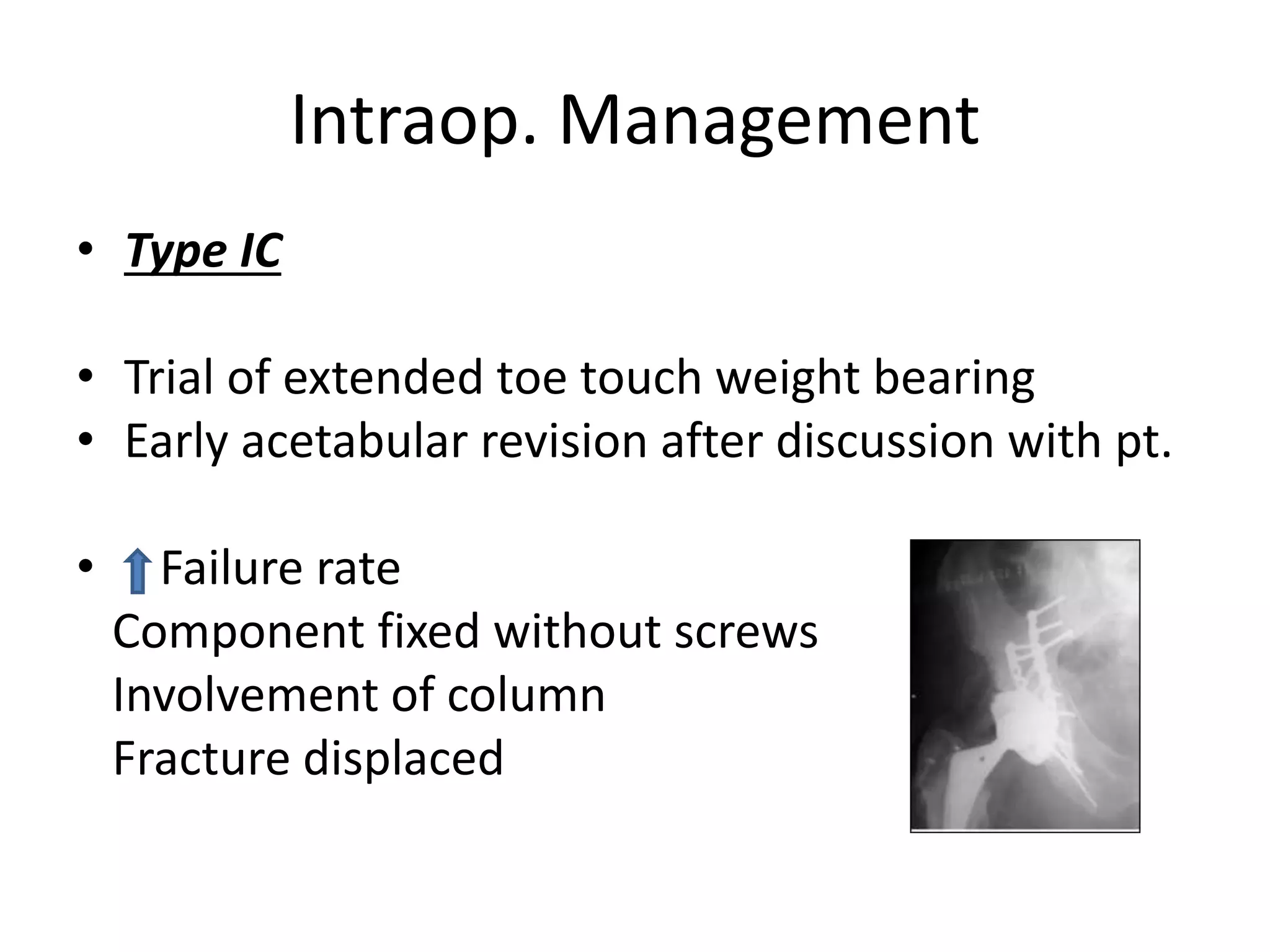 Intraoperative acetabular fracture and pelvic discontinuity in thr | PPTX