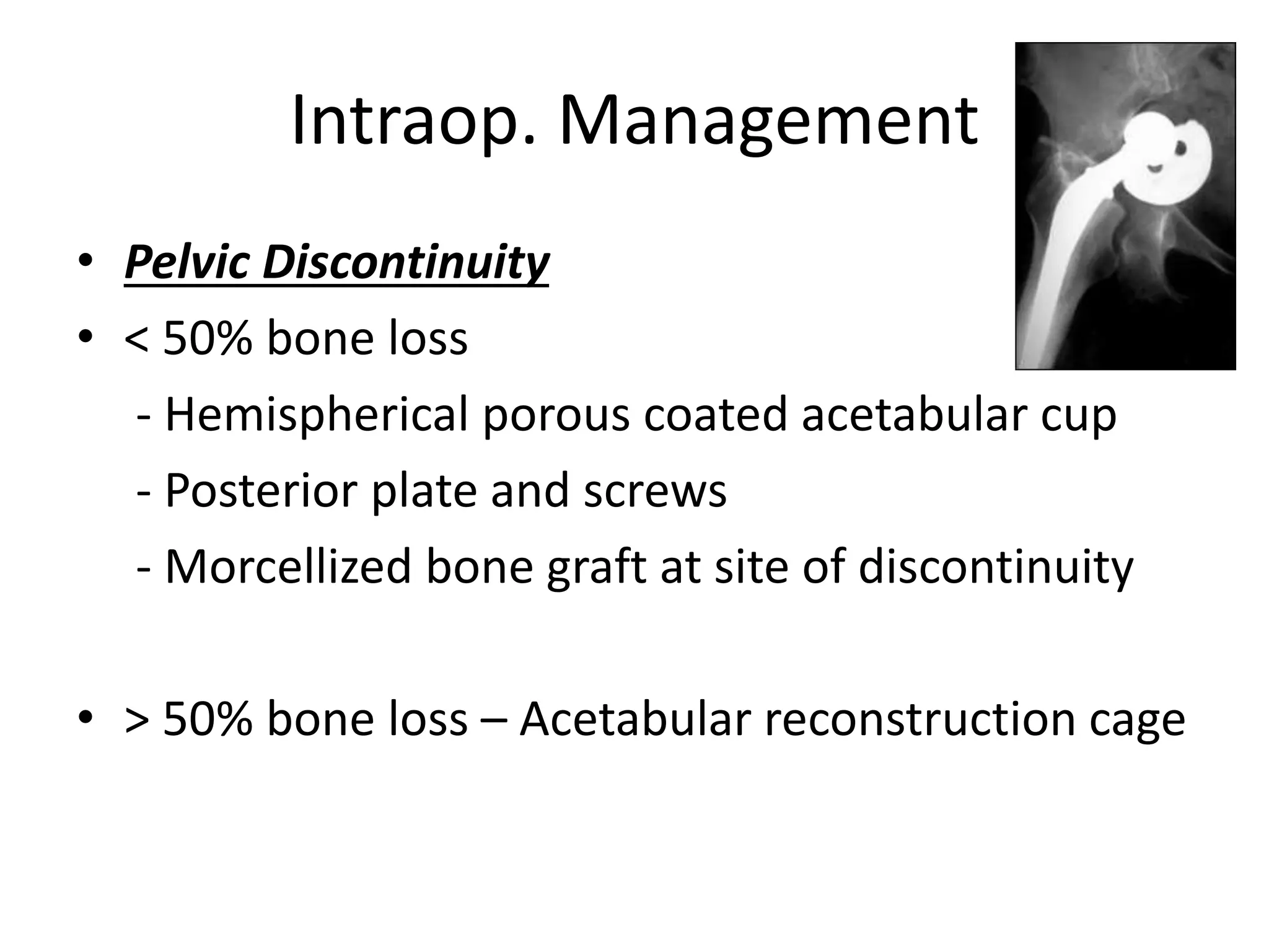 Intraoperative acetabular fracture and pelvic discontinuity in thr | PPTX