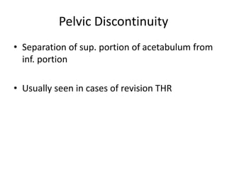 Intraoperative acetabular fracture and pelvic discontinuity in thr | PPTX