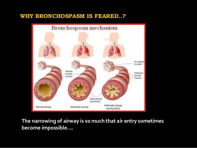 Intraoperative bronchospasm