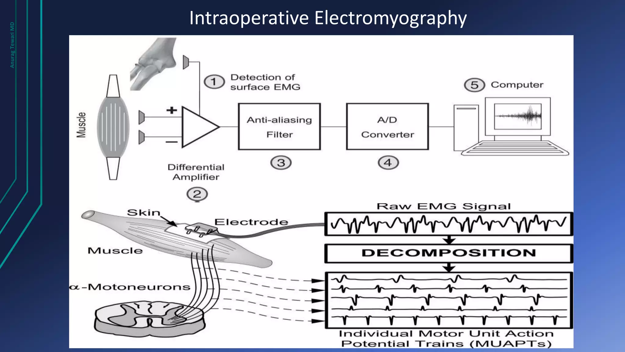 Intraoperative Electromyography (EMG) | PPTX