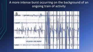 Intraoperative Electromyography (EMG) | PPTX