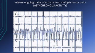 Intraoperative Electromyography (EMG) | PPTX