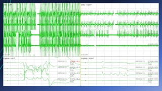 Intraoperative Electromyography (EMG) | PPTX