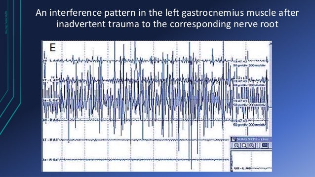 Intraoperative Electromyography (EMG)
