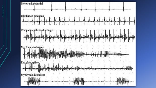 Intraoperative Electromyography (EMG)