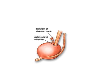 Intraoperative identification & management of lower urinary tract ...