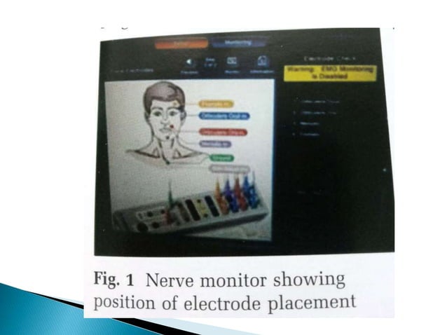 Intra operative nerve monitoring in ent | PPTX | First Aid | Injuries