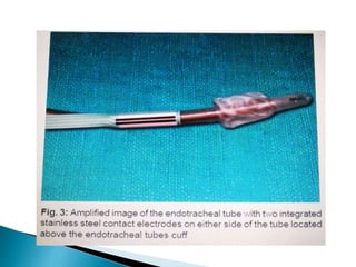 Intra operative nerve monitoring in ent | PPTX