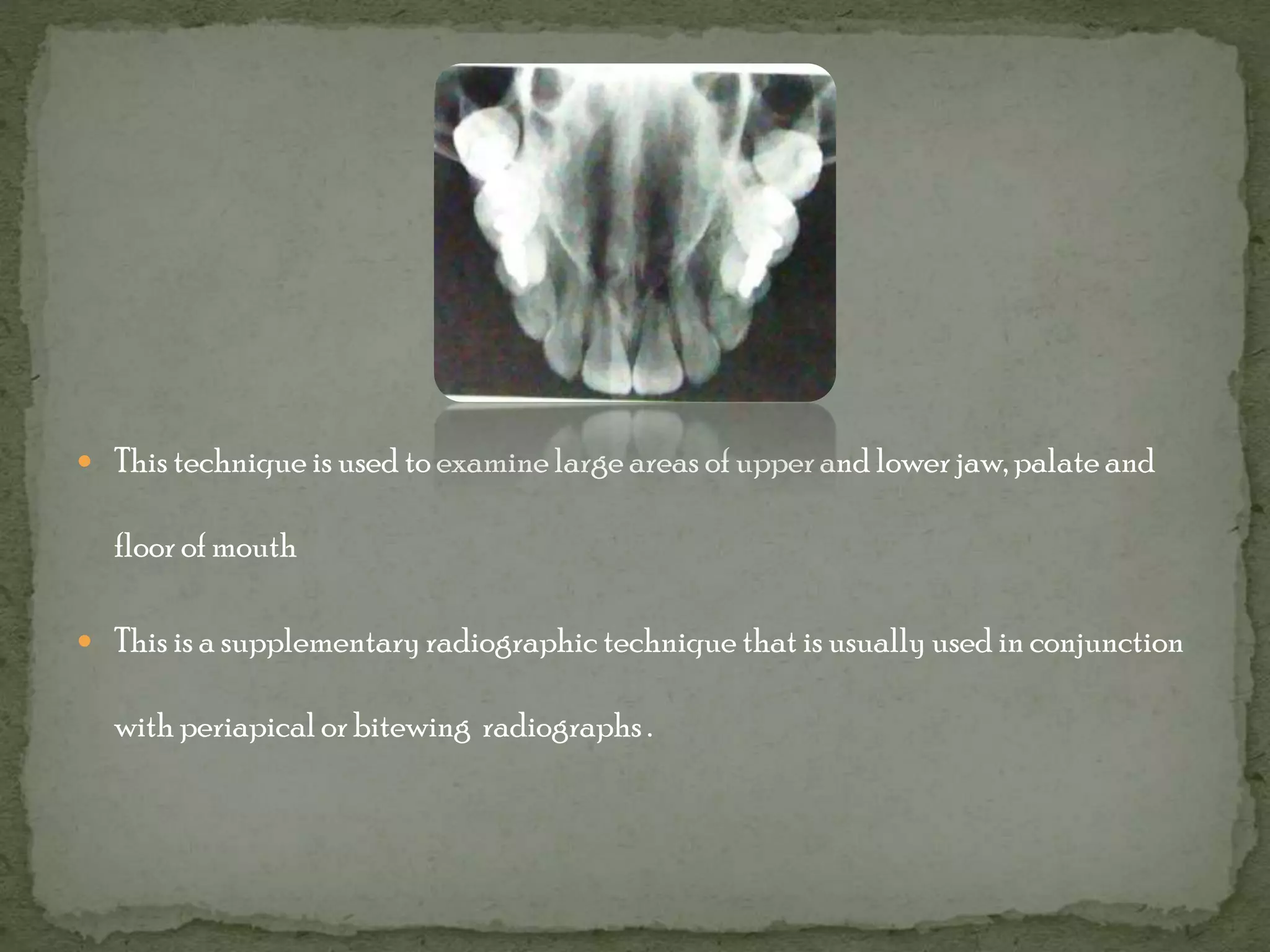 Intraoral radiographic technique ii | PPTX