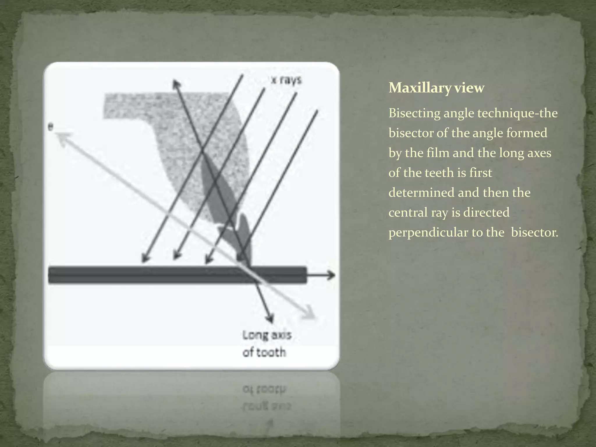 Intraoral radiographic technique ii | PPTX