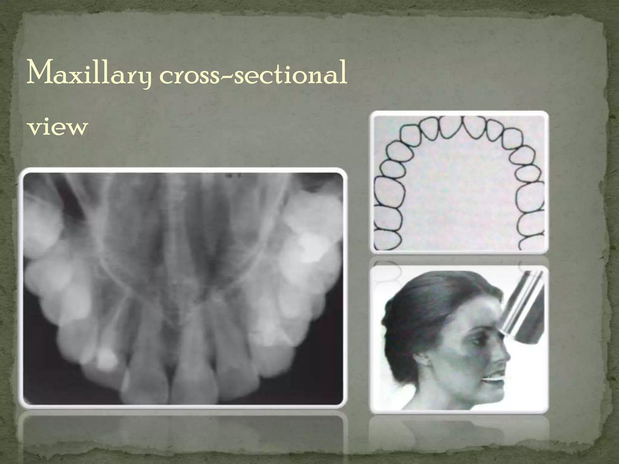 Intraoral radiographic technique ii | PPTX