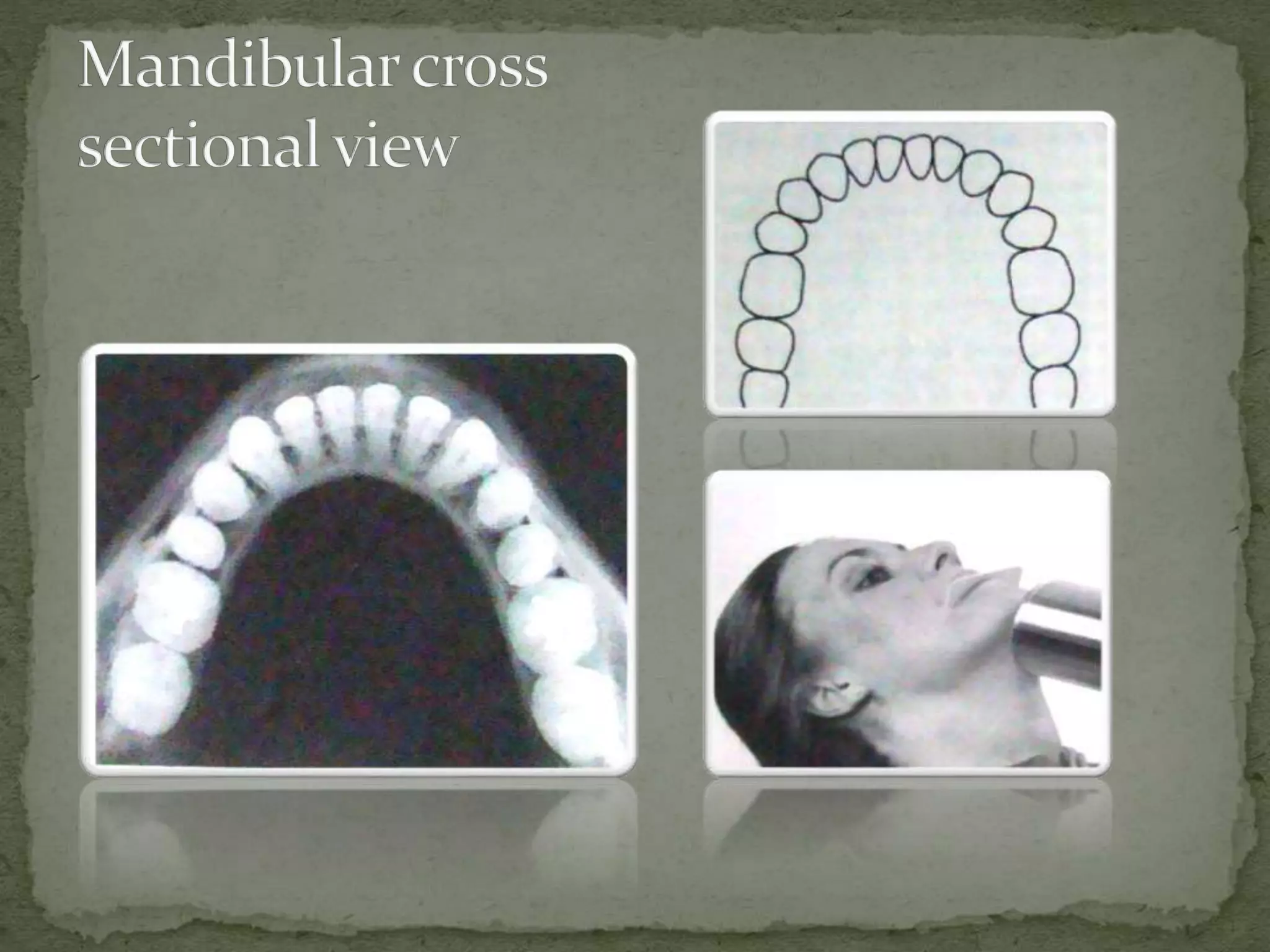 Intraoral radiographic technique ii | PPTX