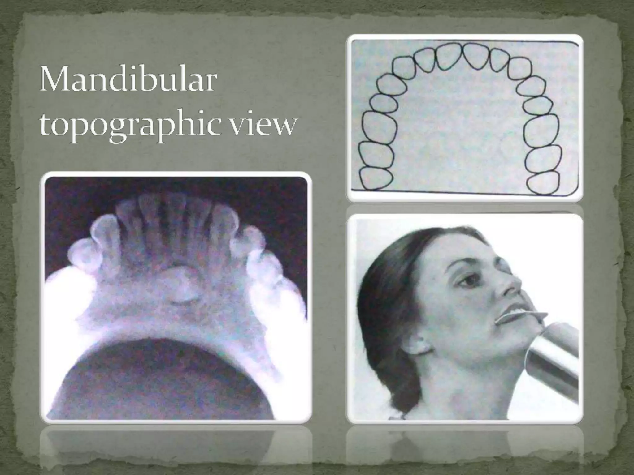 Intraoral radiographic technique ii | PPTX
