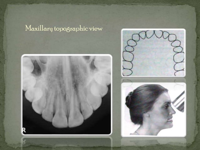 Intraoral radiographic technique ii | PPT