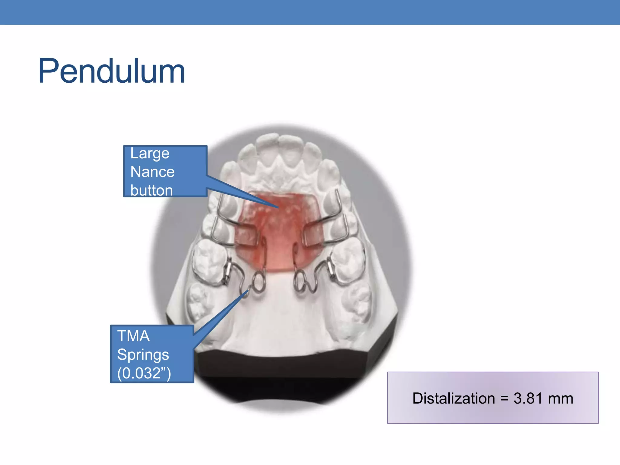 Intraoral Distalizing Devices | PPTX