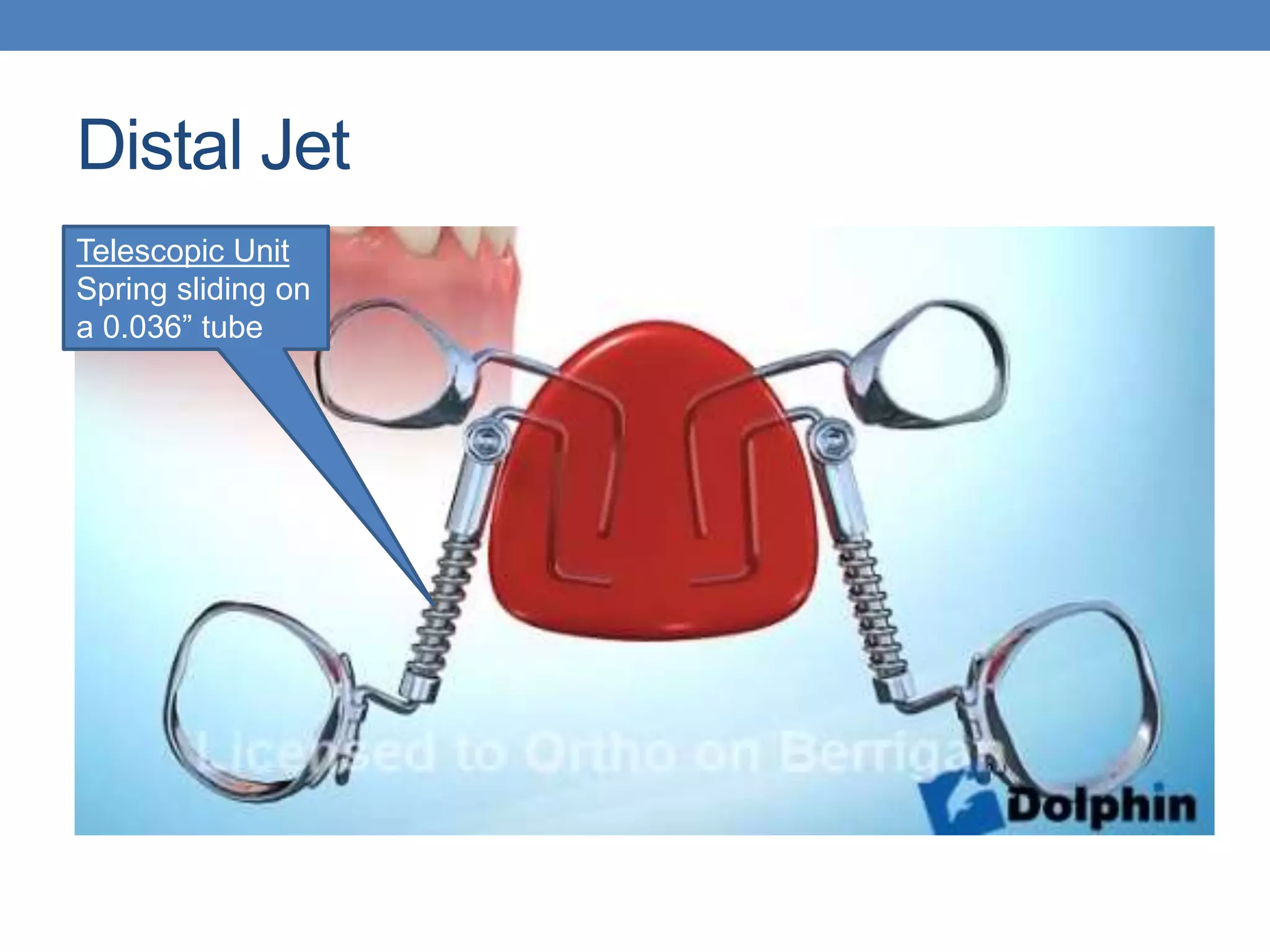 Intraoral Distalizing Devices | PPTX