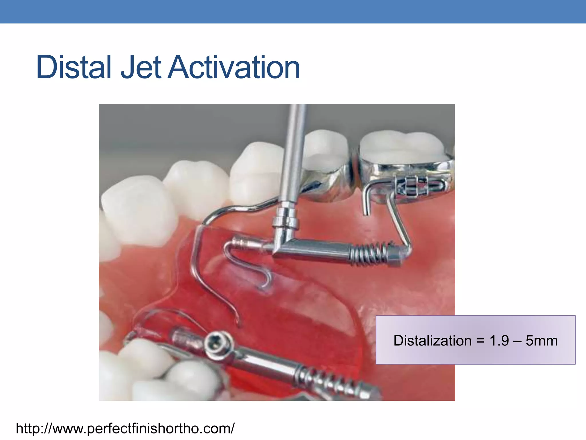 Intraoral Distalizing Devices | PPTX