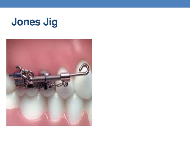 Intraoral Distalizing Devices