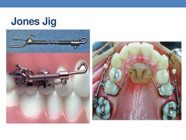 Intraoral Distalizing Devices