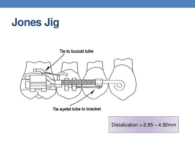 Intraoral Distalizing Devices