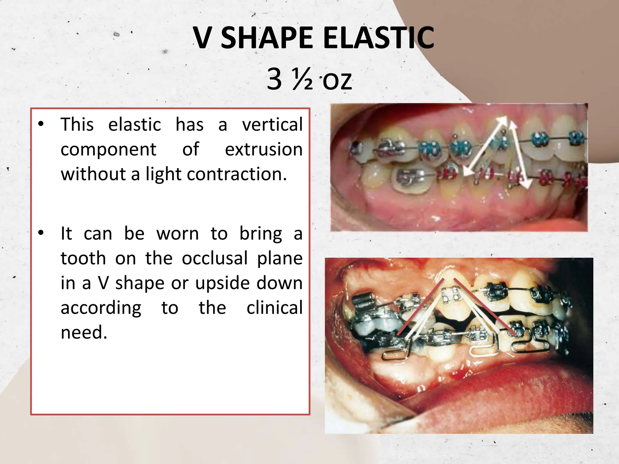 INTRAORAL ELASTICS in orthodontics .pptx