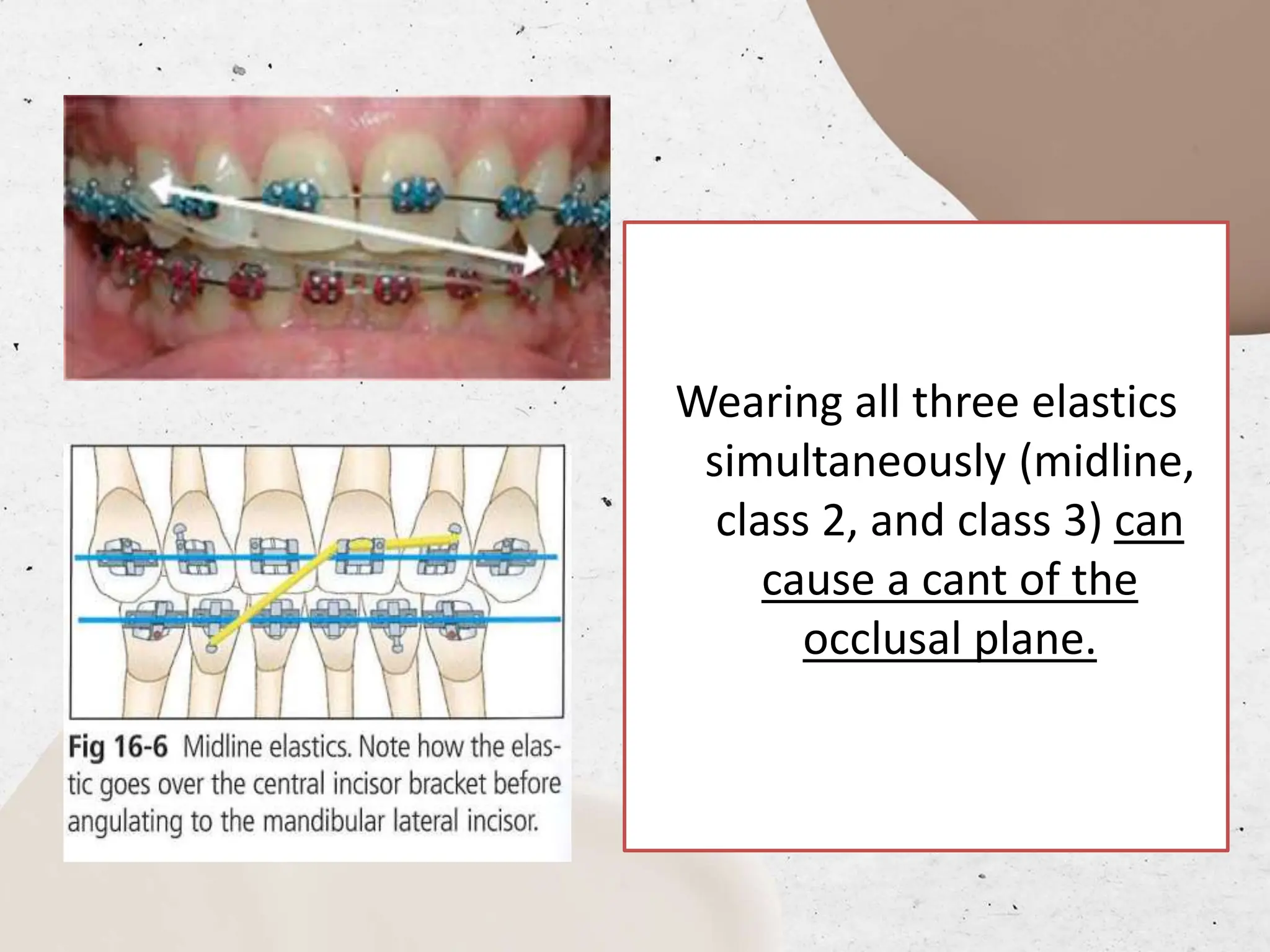 INTRAORAL ELASTICS in orthodontics .pptx
