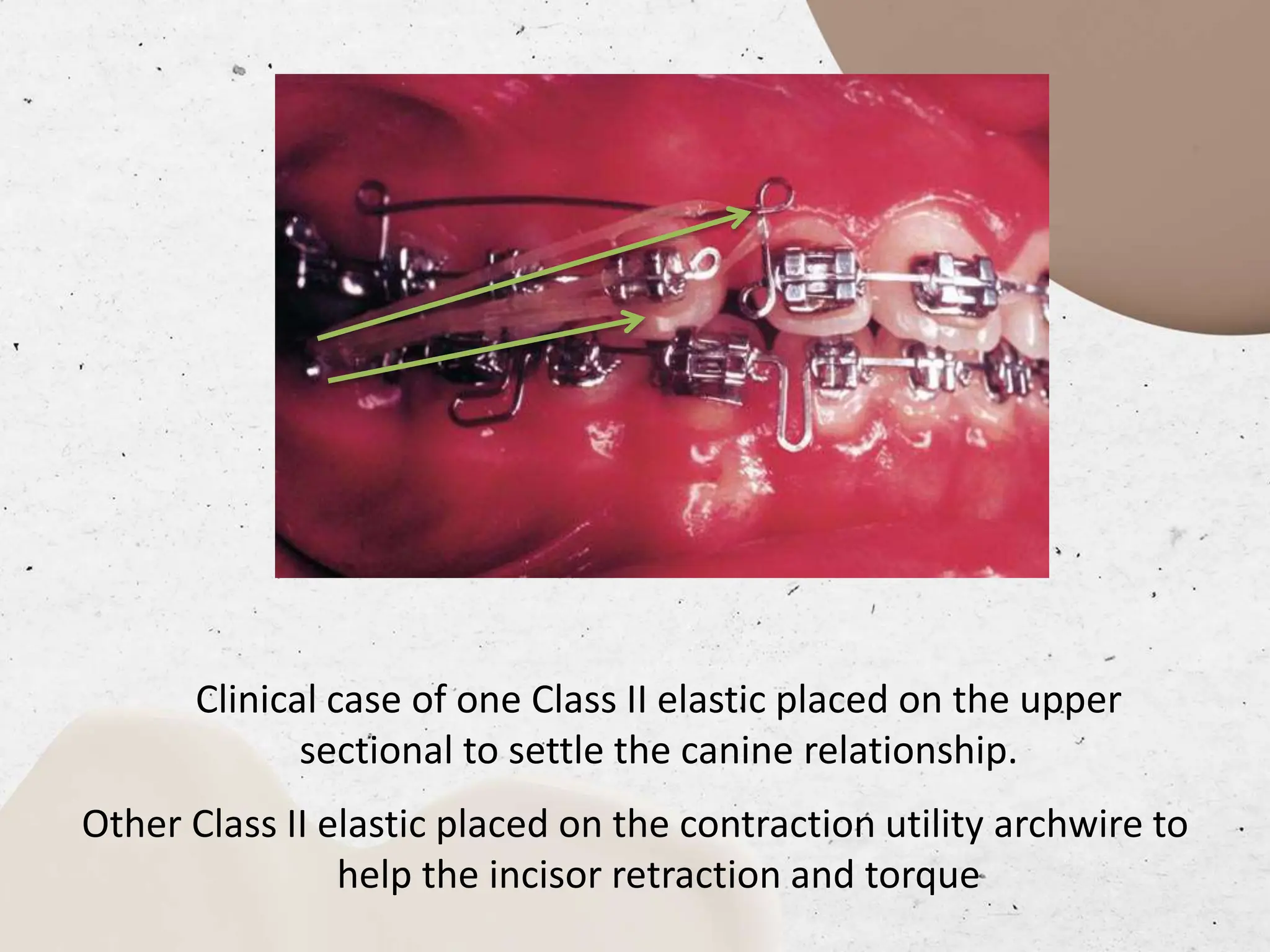 INTRAORAL ELASTICS in orthodontics .pptx