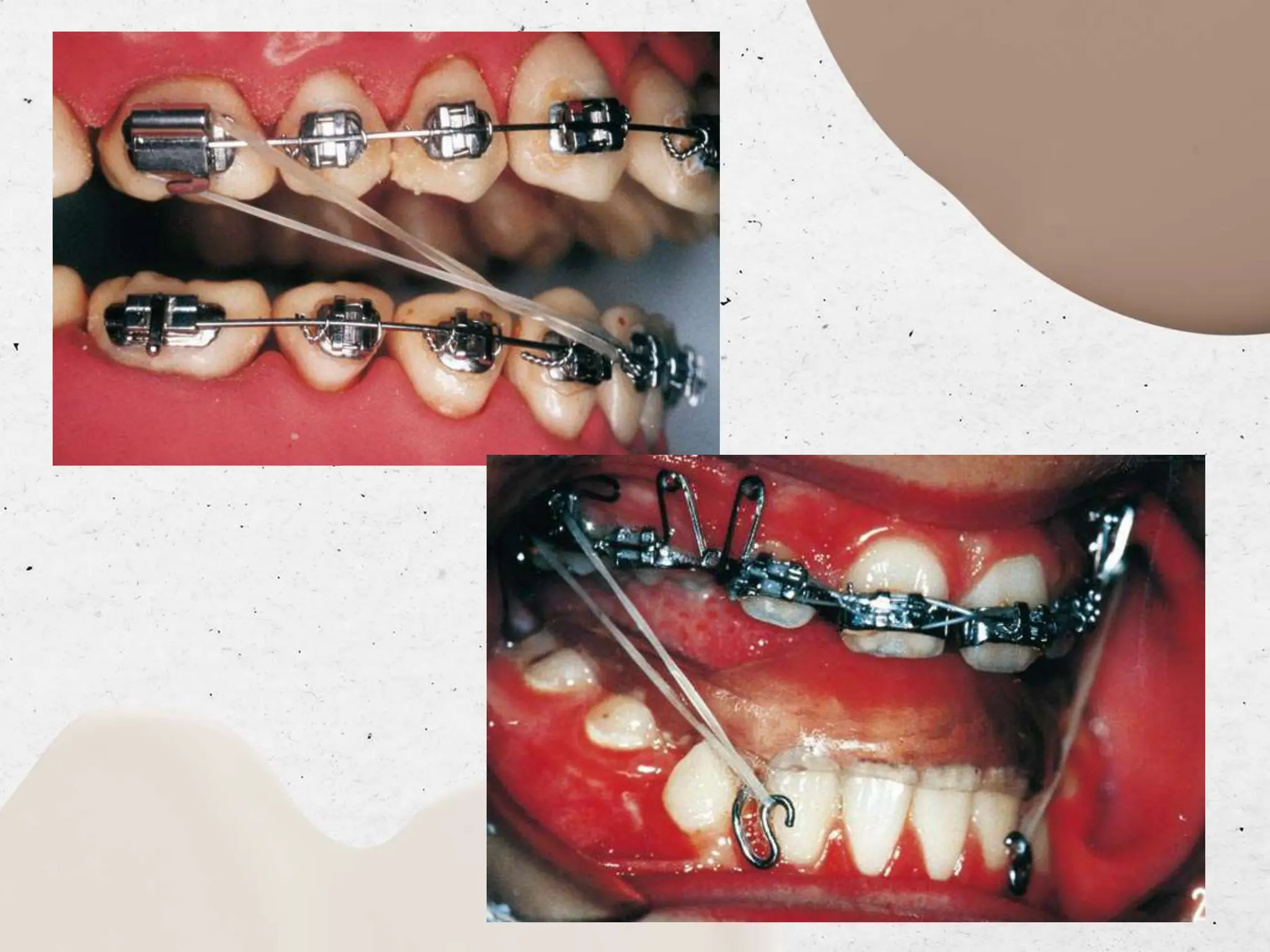 INTRAORAL ELASTICS in orthodontics .pptx