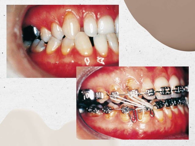 INTRAORAL ELASTICS in orthodontics .pptx