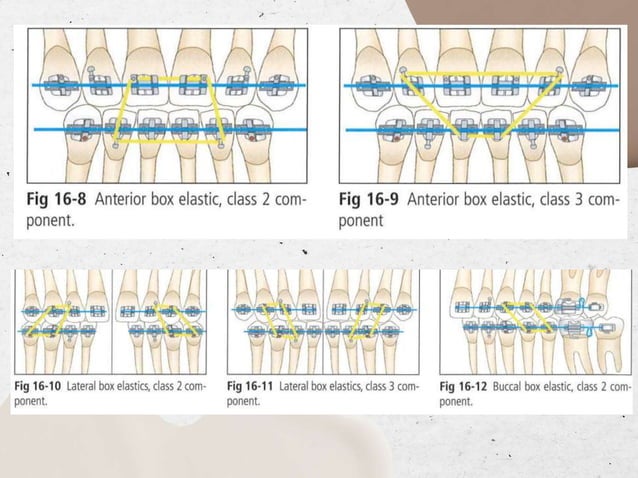 INTRAORAL ELASTICS in orthodontics .pptx