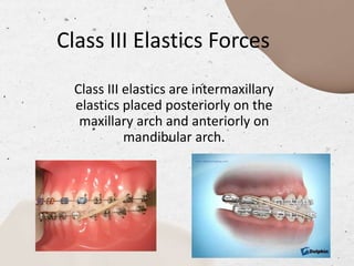 INTRAORAL ELASTICS in orthodontics .pptx