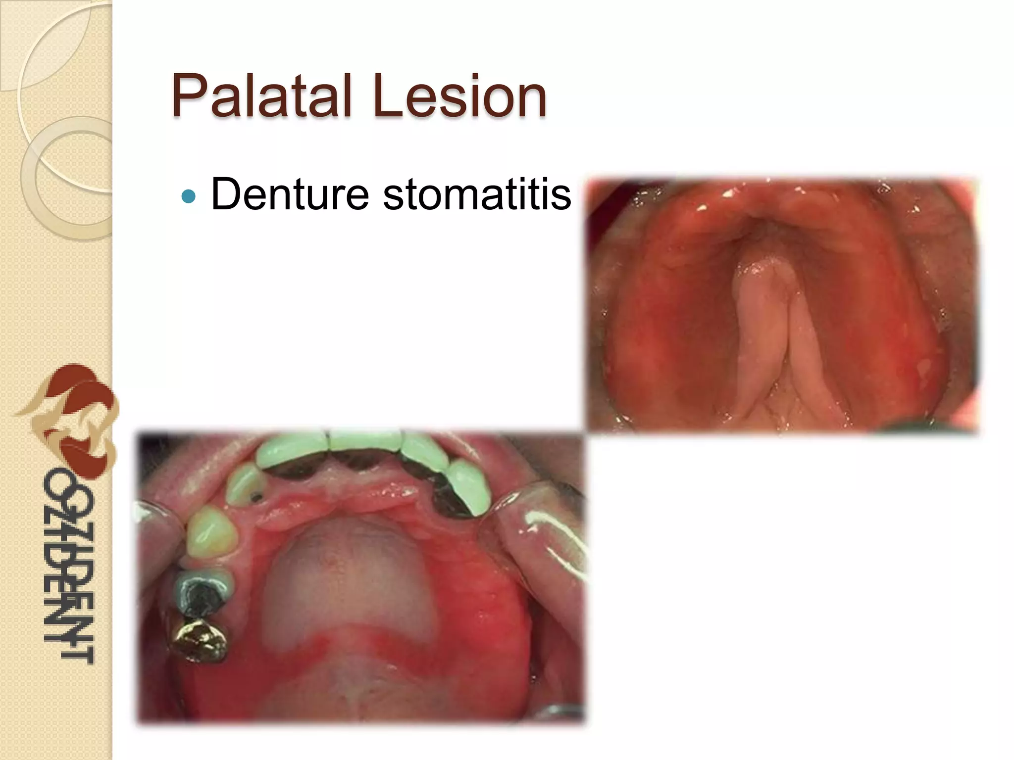 Intra oral examination | PPTX
