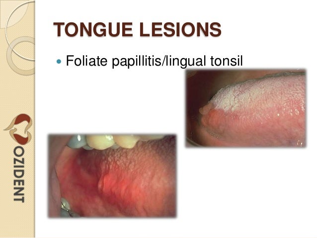 Intra oral examination