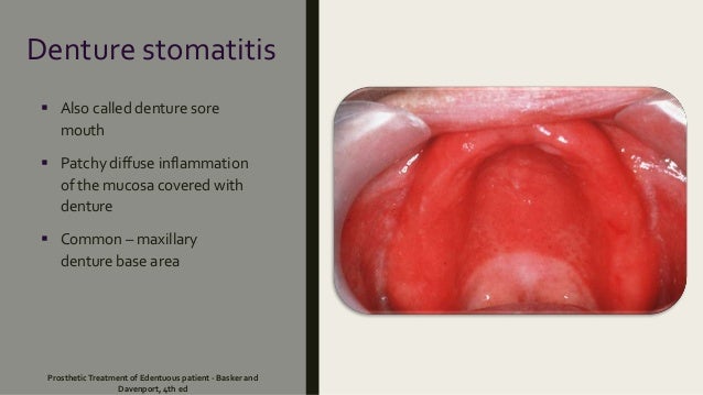 Intra oral examination