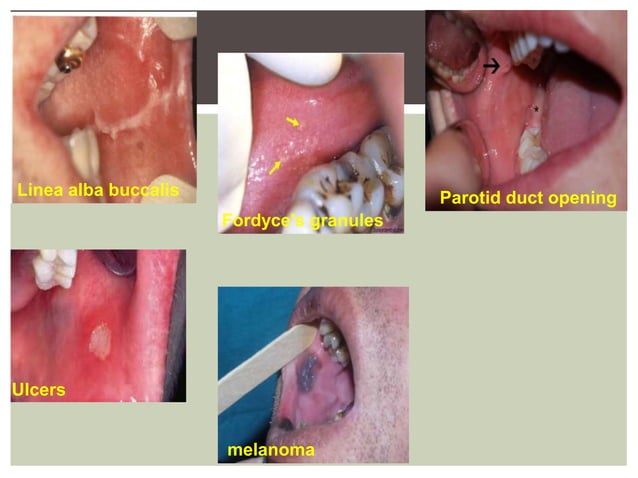 Intra oral examination | PPTX