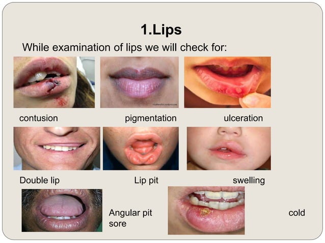 Intra oral examination | PPTX | Dental Health | Diseases and Conditions