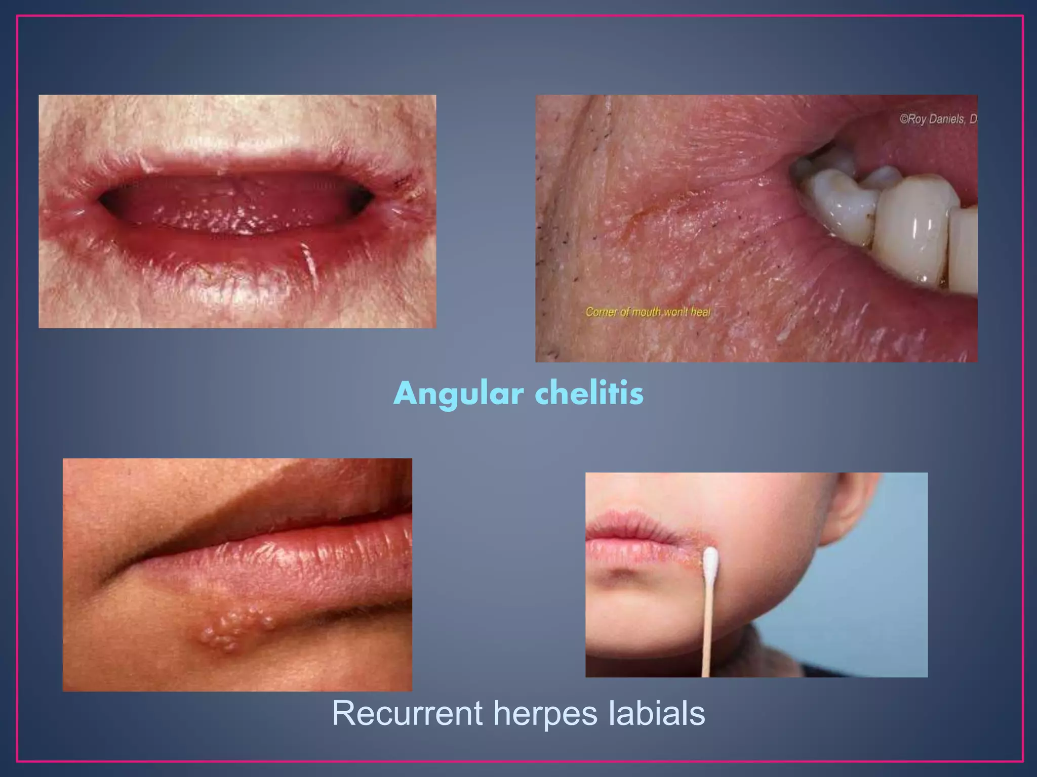 Intra oral examination (lips and labial mucosa) | PPTX