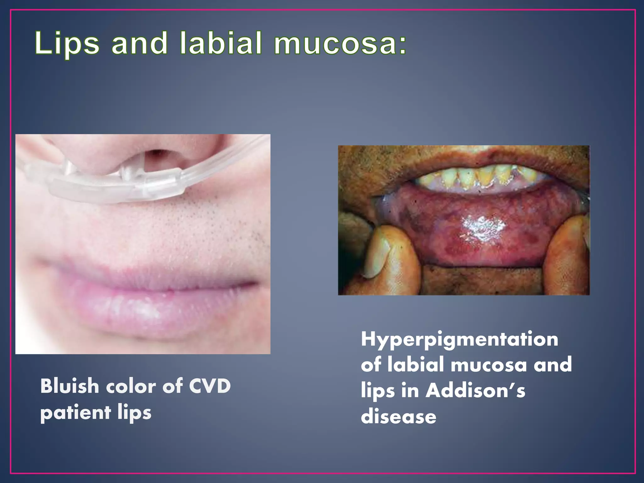 Intra oral examination (lips and labial mucosa)